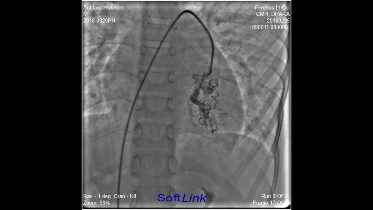 Master Ashfaqur 12 Yrs 22 Kg AV Fistula Coil embolization done by 6x1 ...