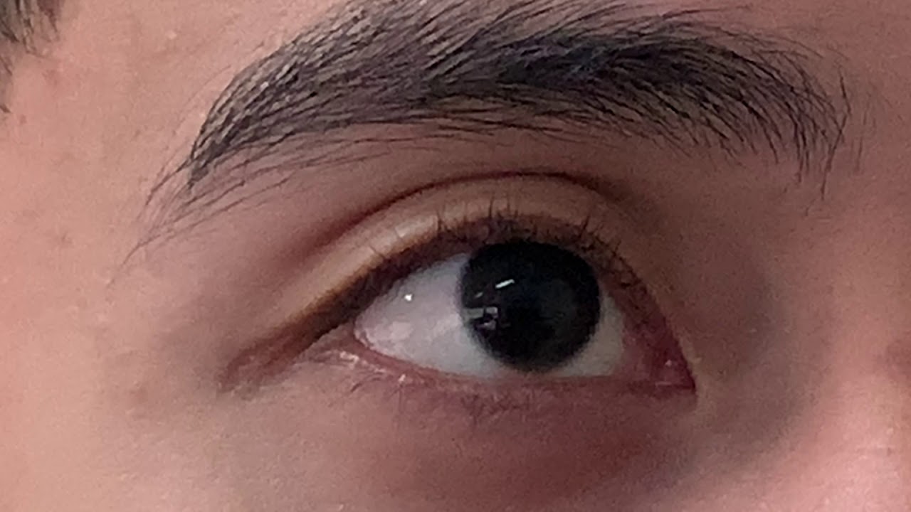 Tullio Phenomenon for Nystagmus - YouTube