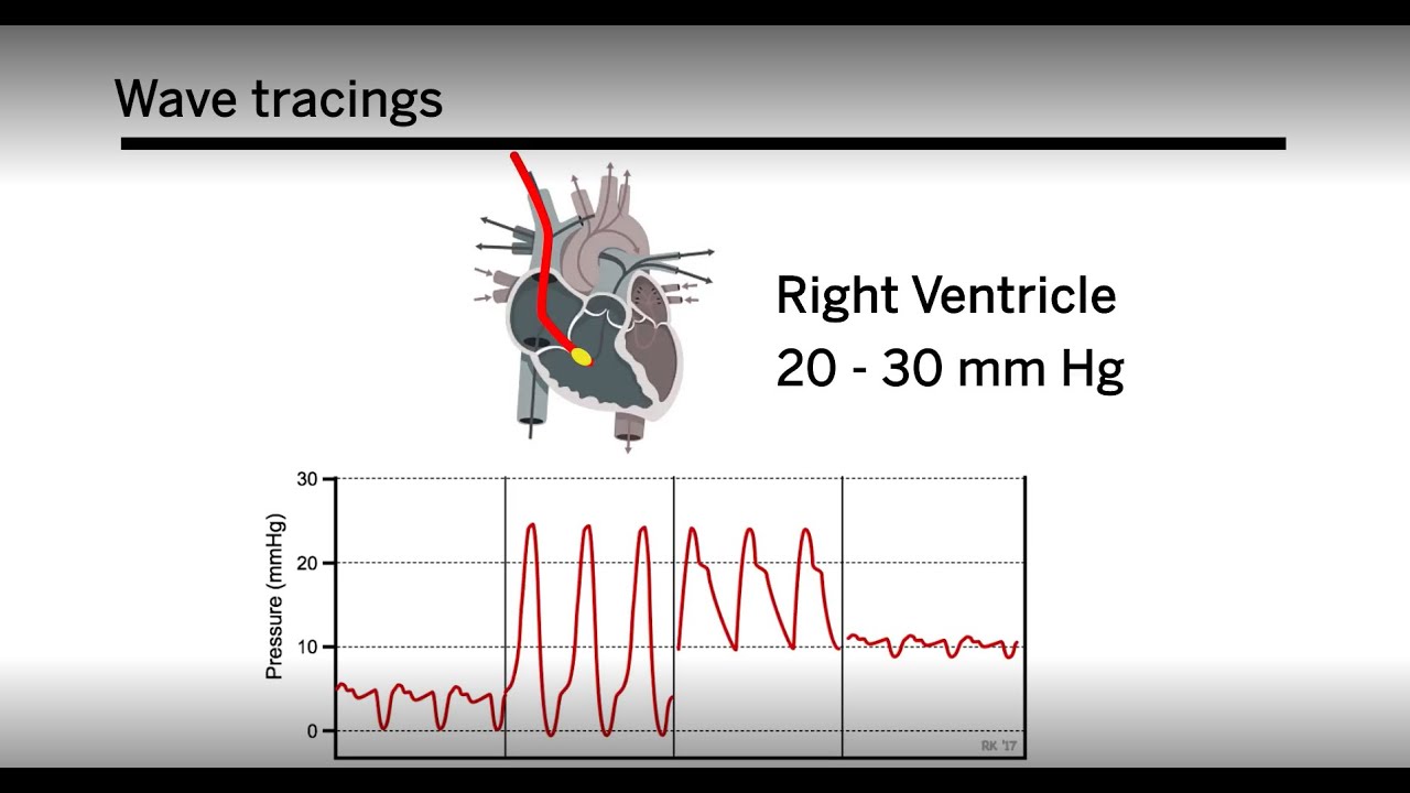 Diagnosis of Pulmonary Hypertension - YouTube
