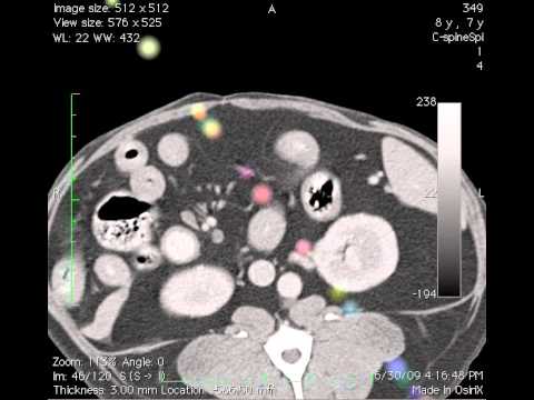 tumor in abdominal cavity, dog, CT www.ctinvet.com - YouTube