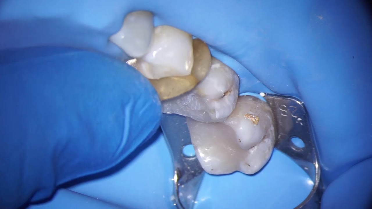 Sectional matrix placement - YouTube