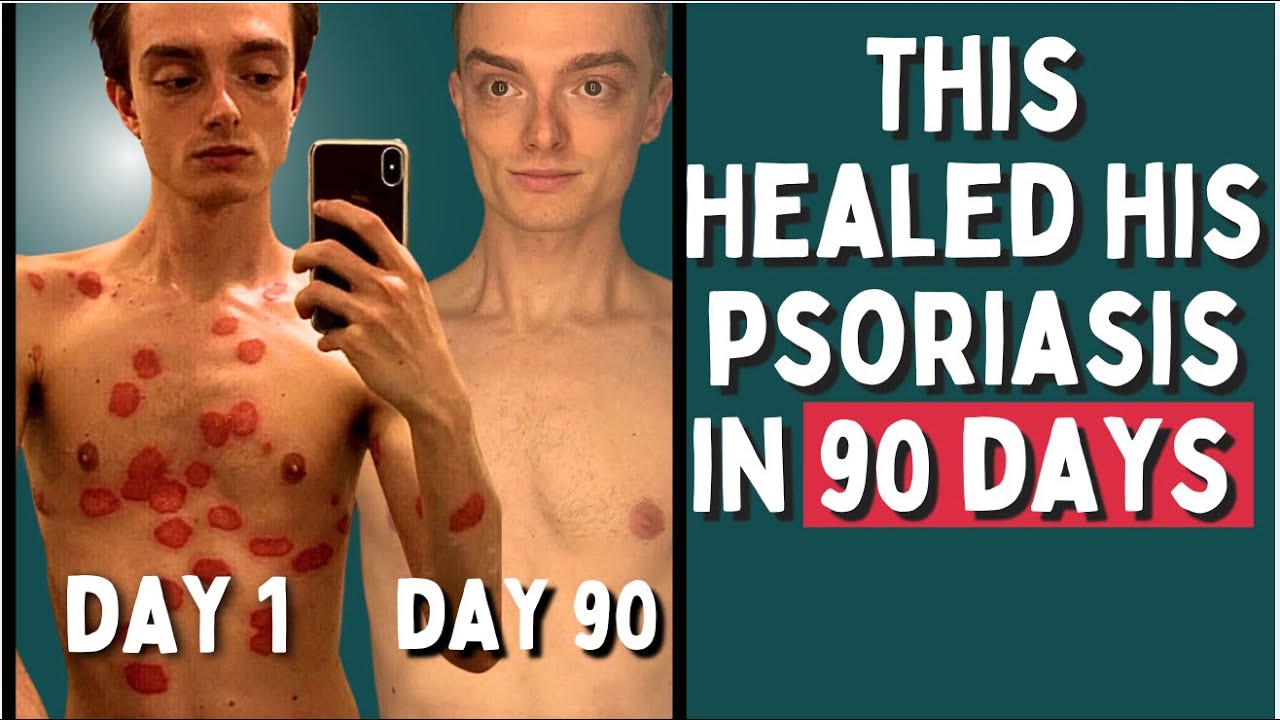 How Cody Healed Psoriasis Naturally (step by step protocol breakdown ...