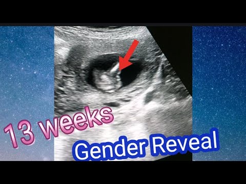 EARLIEST gender reveal ultrasound | Anterior Placenta means baby boy ...