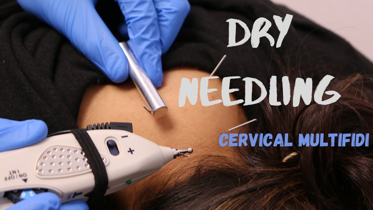 Dry Needling the CERVICAL spine for HEADACHES and NECK pain!! - YouTube