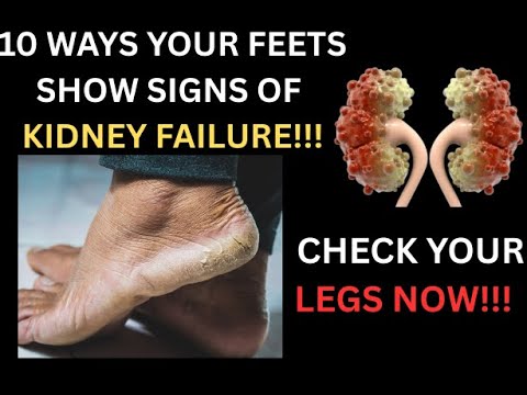 10 Toxic Signs of Kidney Failure in Your Feet - YouTube