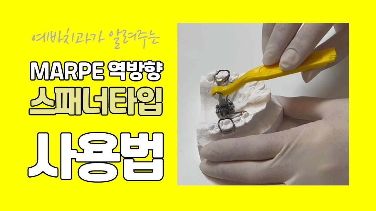 예바치과가 알려주는 MARPE 역방향 Spaner Type 올바른 사용법 - YouTube