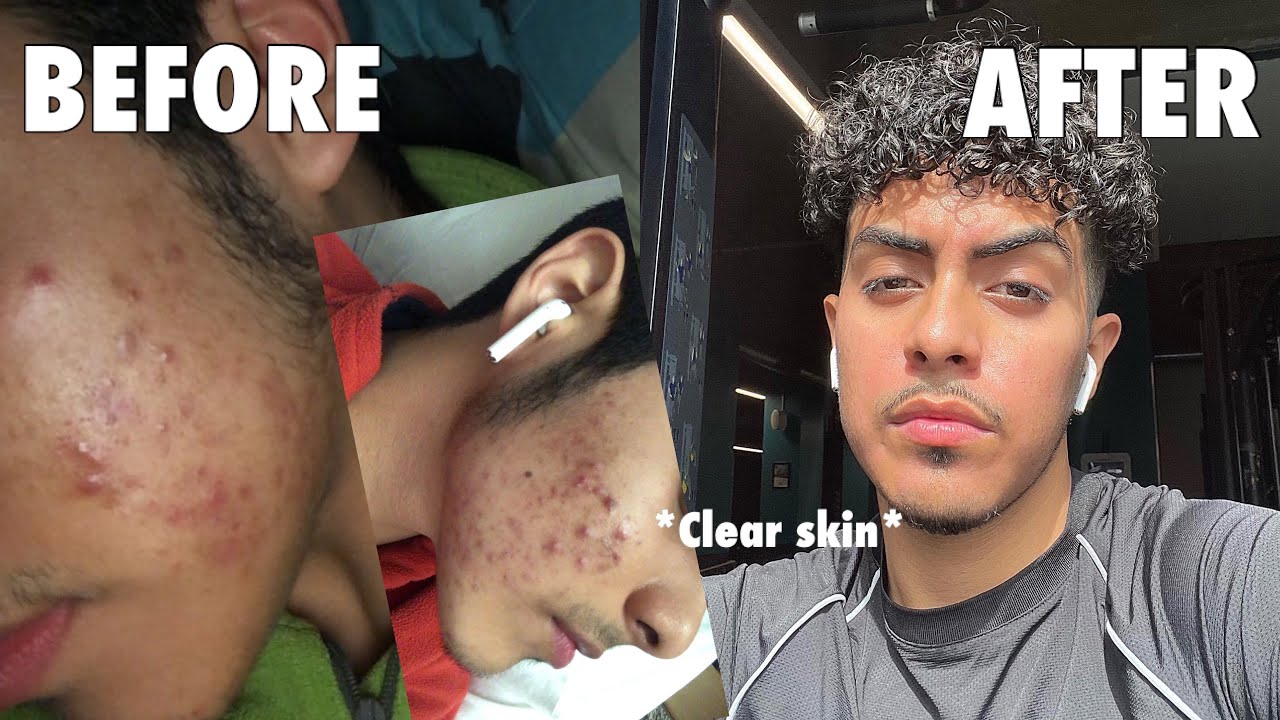 HOW TO GET RID OF ACNE *TIPS & SECRETS TO CLEAR YOUR FACE* | ULTIMATE ...