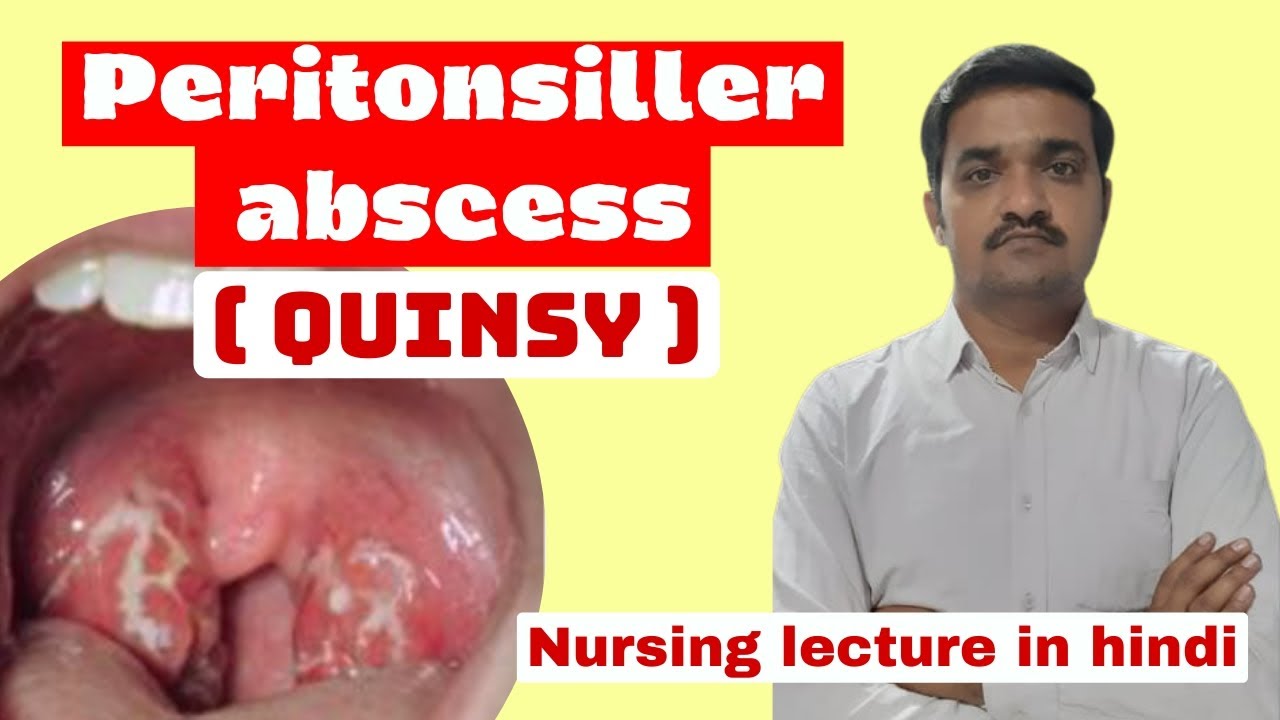 peritonsillar abcess in hindi | cause, symptoms, management | quinsy ...