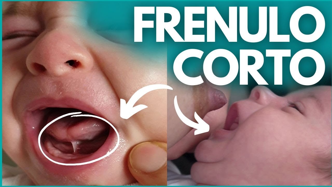 FRENULO LINGUALE CORTO DEL NEONATO: Cos’è, come valutarlo, cosa fare e ...