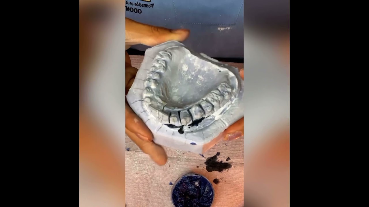 Elaboración de Set-up, Ortodoncia - YouTube