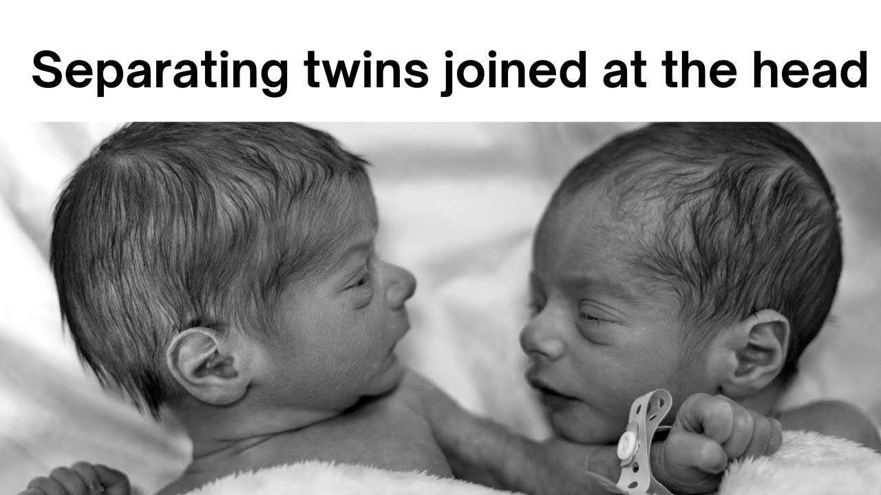 “How Surgeons Separated Twins Joined by the Head – A Miracle of Modern ...