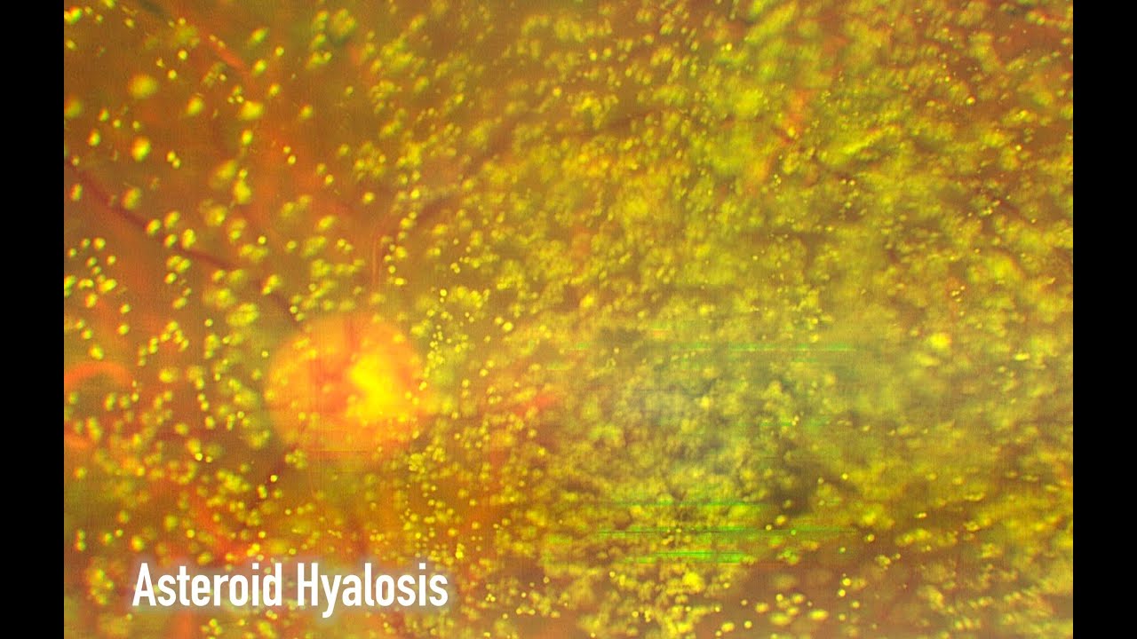 Asteroid Hyalosis - another type of eye floaters | Phacovitrectomy ...