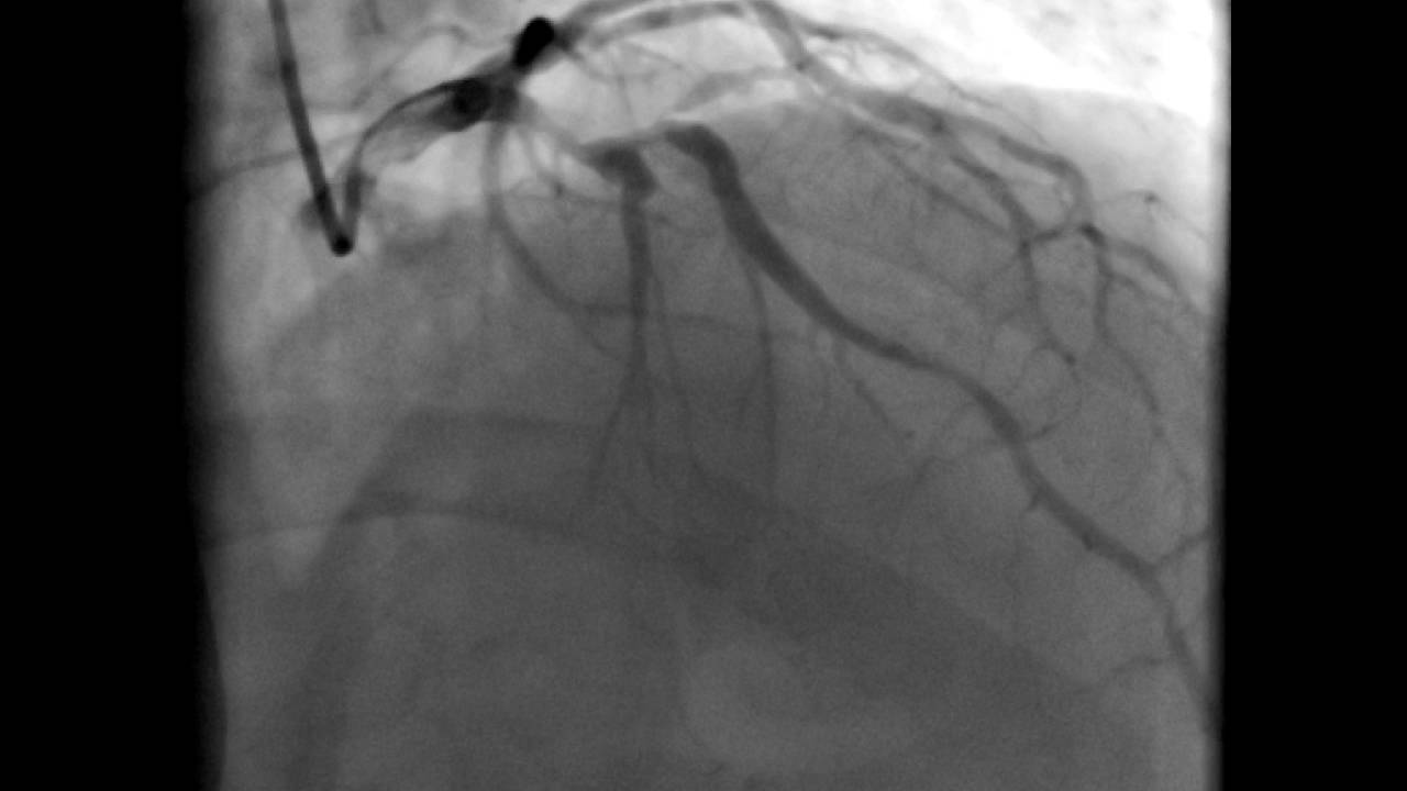Coronary artery perforation-Angiogram(cranial view) - YouTube