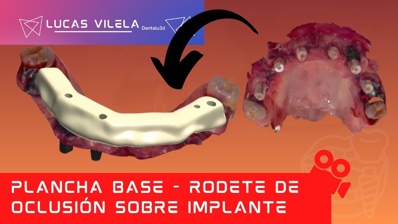 PLANCHA BASE - RODETE DE OCLUSIÓN SOBRE IMPLANTE / #3SHAPE #dentist # ...