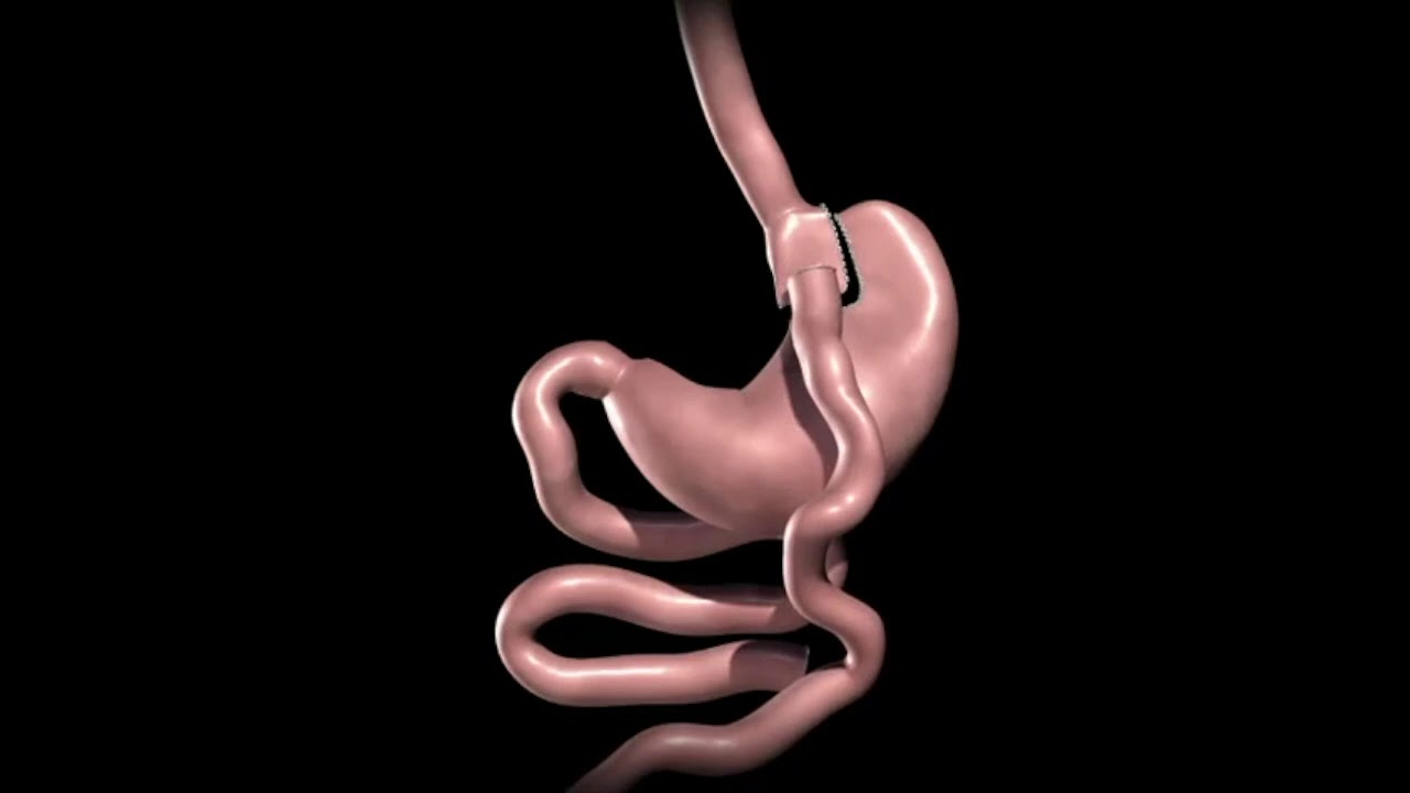 Bypass Y de Roux - YouTube