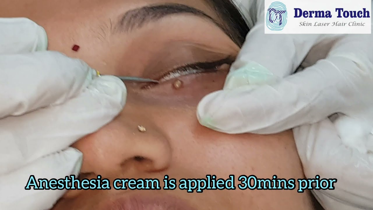 Big Milia on eyelid पलक पर गांठ - YouTube