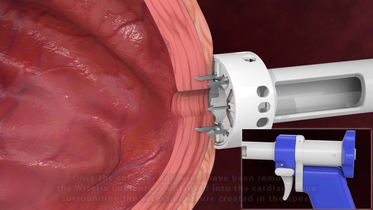 Novogate Medical - Simplify Access- Apical Closure Simplified. - YouTube
