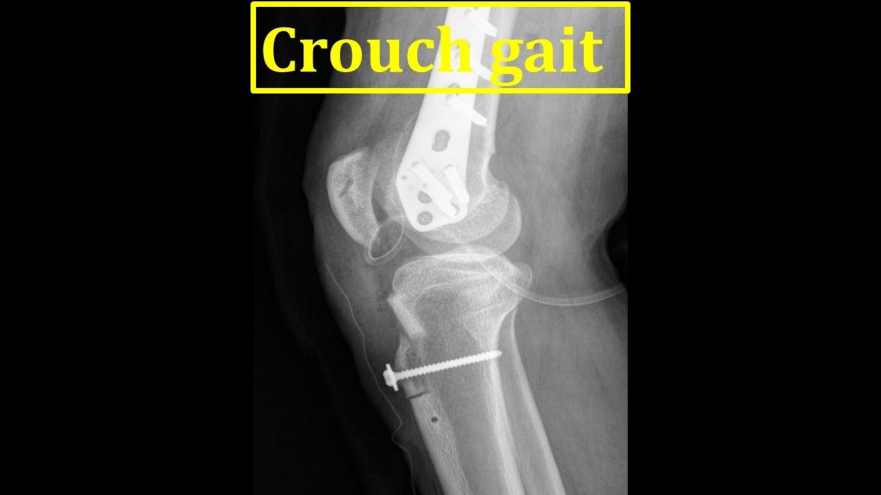 Ep.8 Crouch gait - YouTube