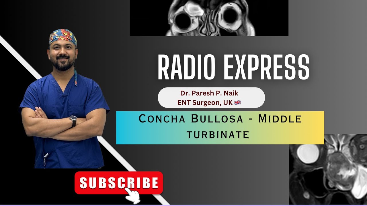 How to Identify Concha Bullosa of Middle Turbinate on CT Scan. - YouTube