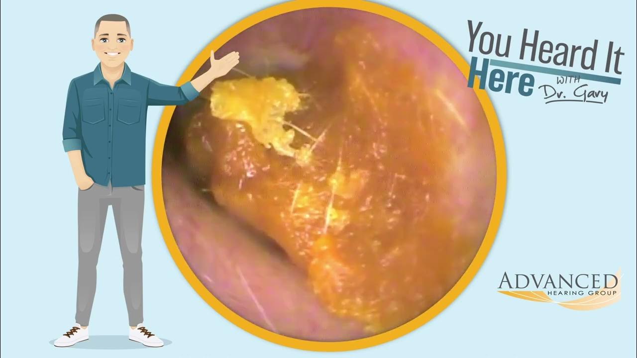 Ear Wax Removal Vlog #79: Peekaboo Eardrums and Giant Wax Chunks - YouTube