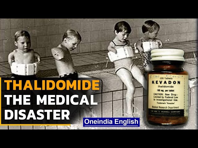 Thalidomide Children Amniotic Band Sequence In Child Of Thalidomide