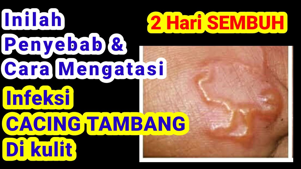 Cara Cepat Mengatasi / Menyembuhkan Infeksi Cacing Tambang Di Kulit ...