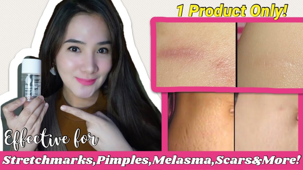 PAANO MAALIS ang STRETCHMARKS & PEKLAT? | PAMPATANGGAL NG MELASMA ...