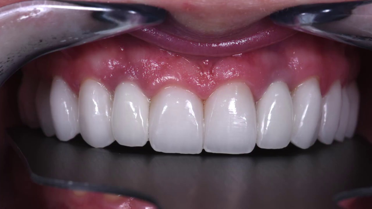 Dental Implants Procedure in Midtown NYC - Dr. Alex Rubinov - Cosmetic ...