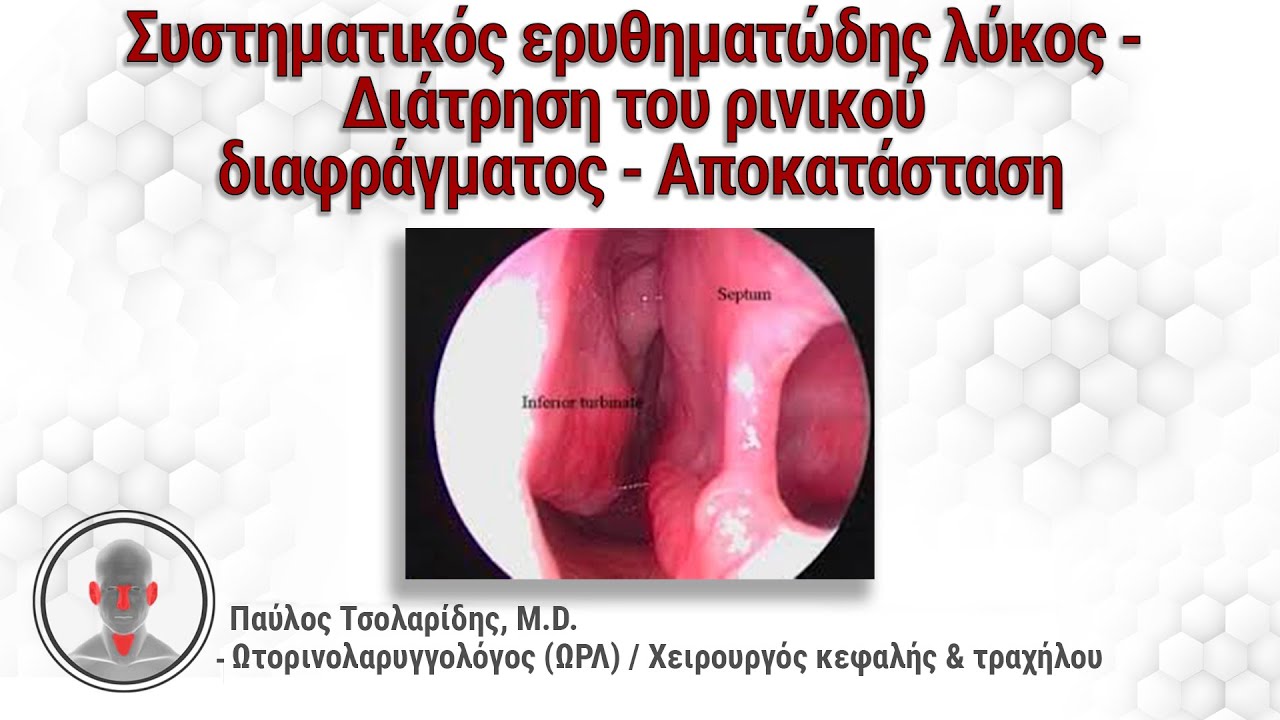 Συστηματικός ερυθηματώδης λύκος - Διάτρηση του ρινικού διαφράγματος ...