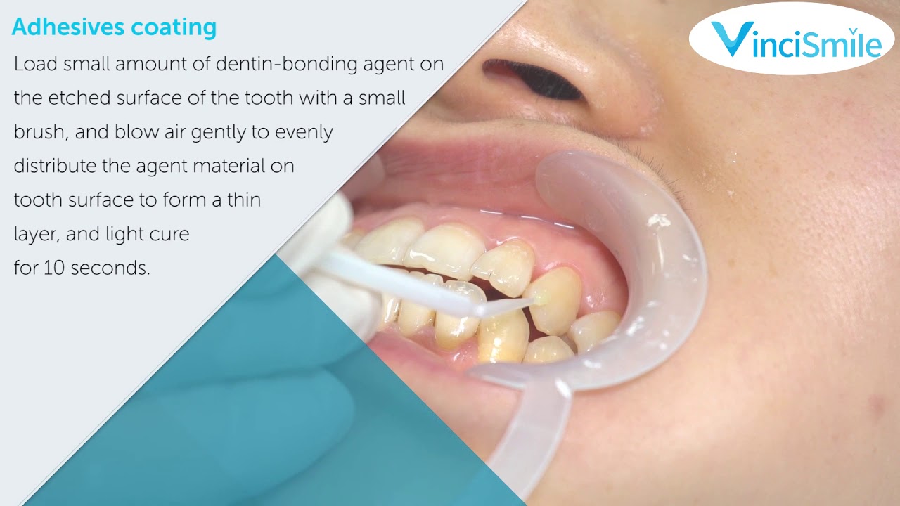 Work Tips: Attachment Bonding - YouTube