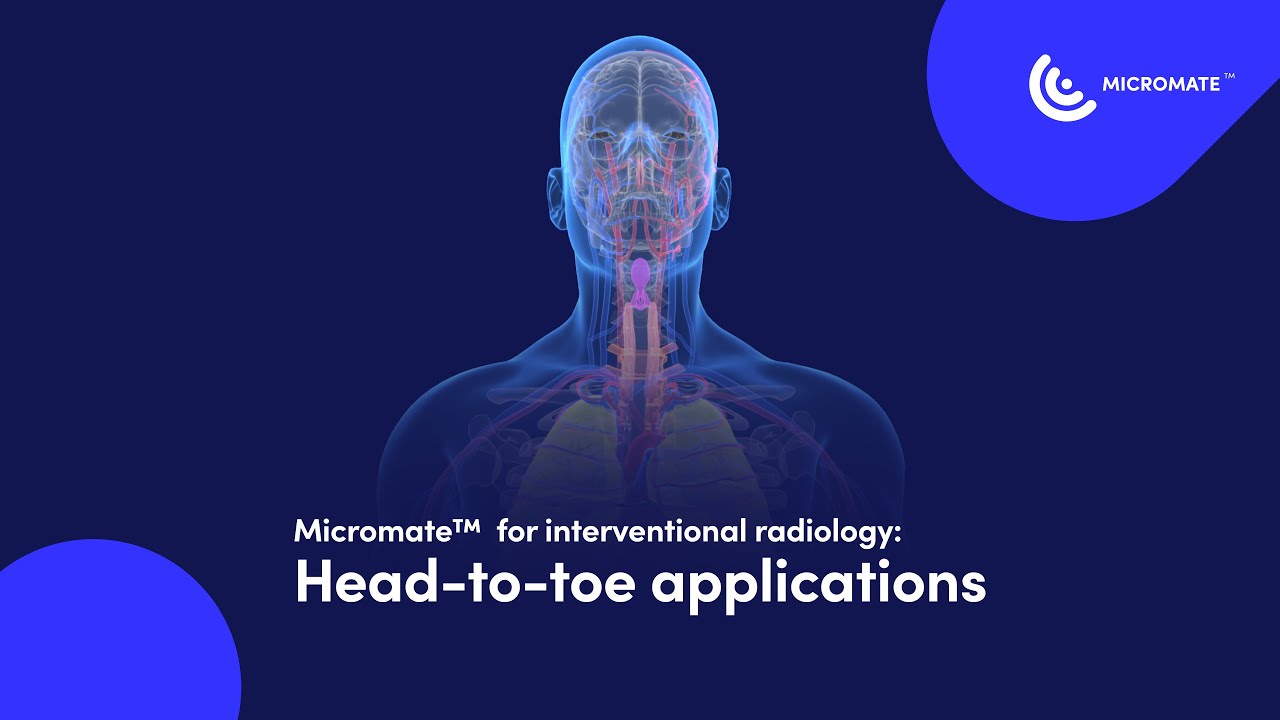 Micromate™ - Interventional Radiology procedures from head to toe - YouTube