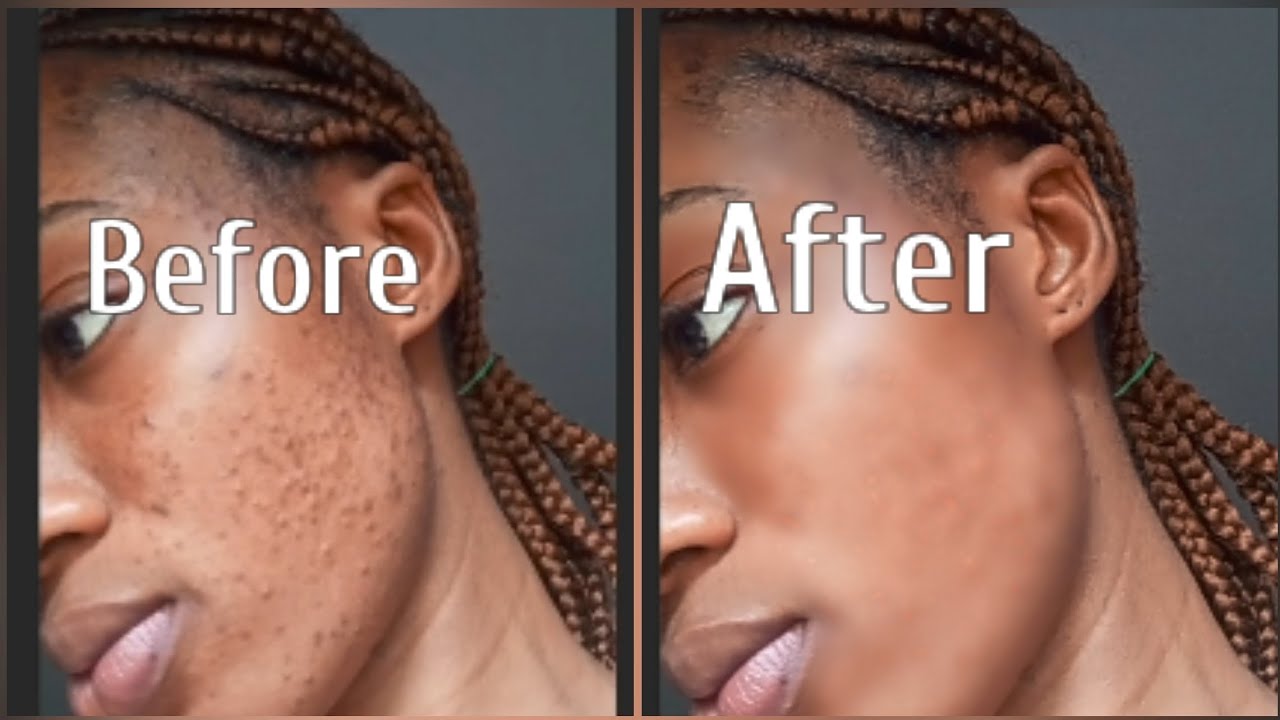 Skin Retouching. Remove Acne and Pimples using Photoshop - YouTube
