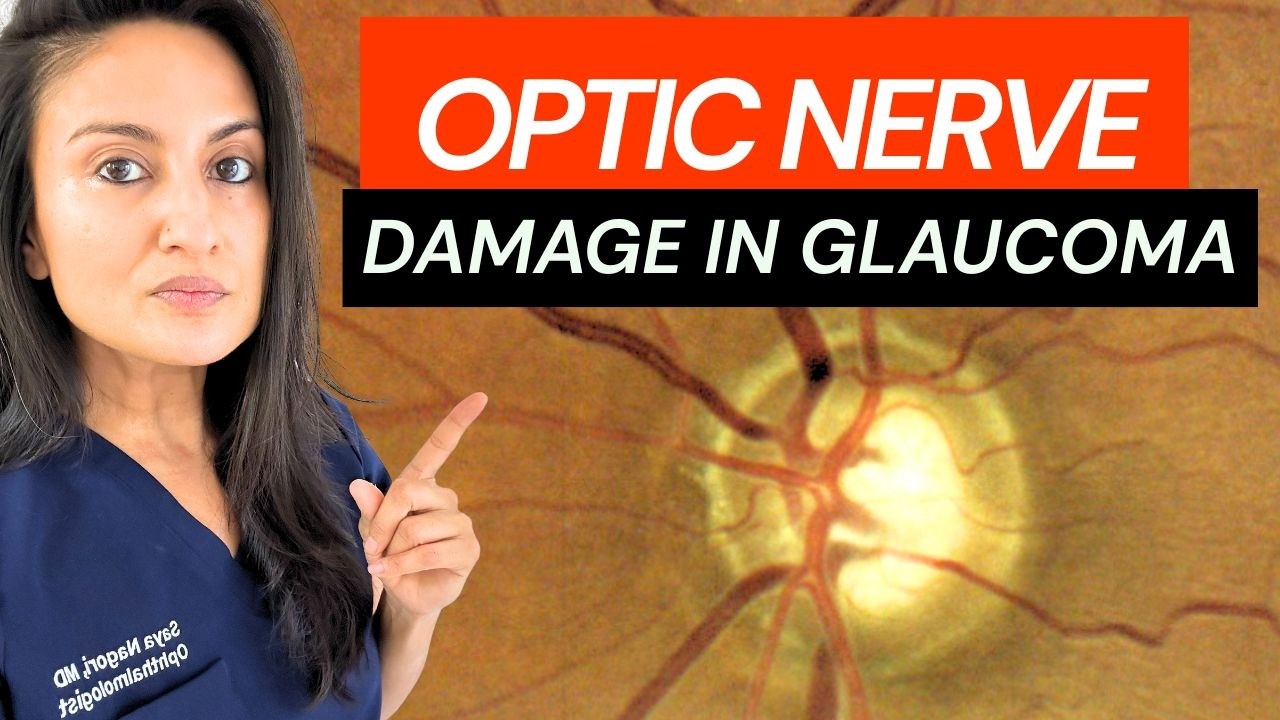 Glaucoma Optic Nerve Damage Explained By Glaucoma Specialist | Optic ...