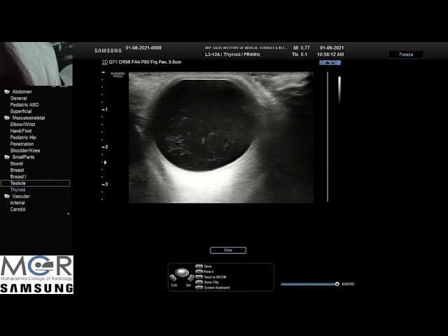 Vitreous Hemorrhage Ultrasound
