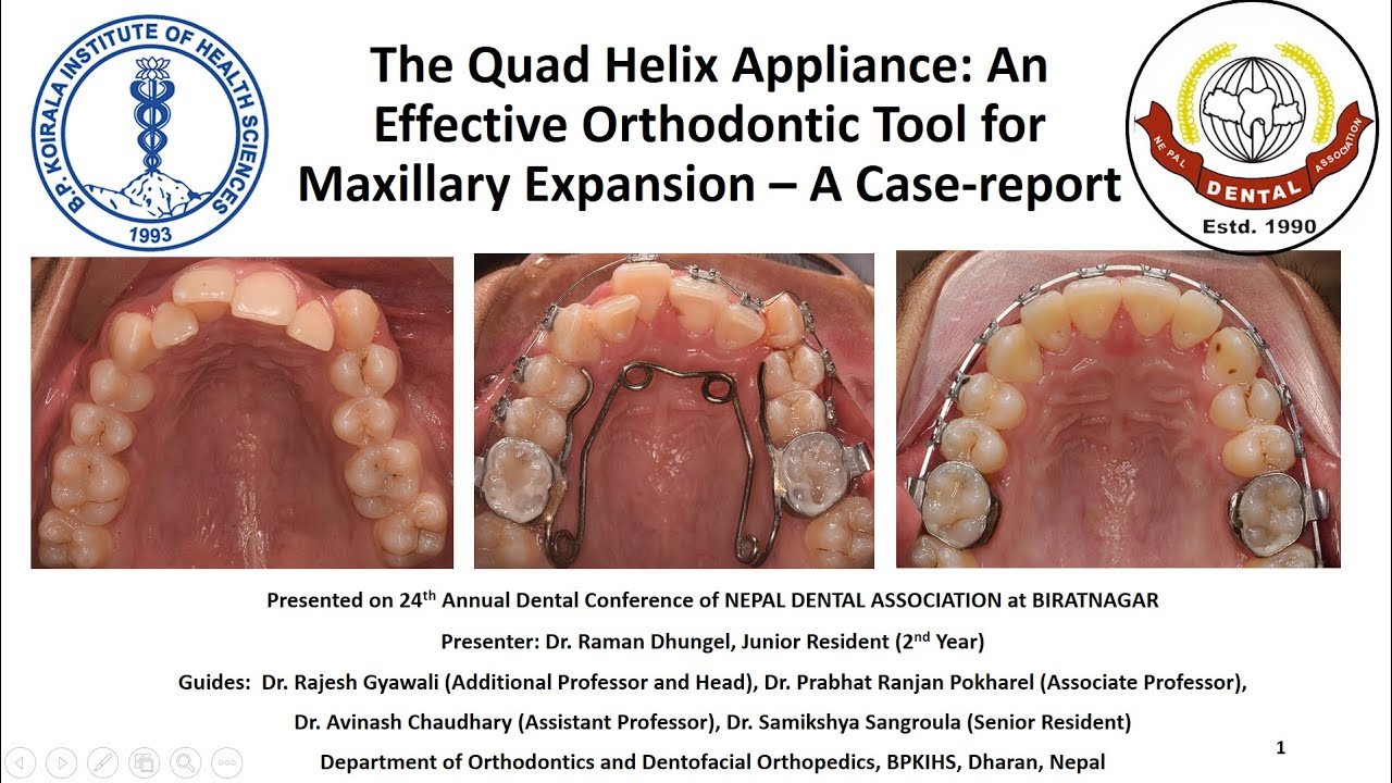 The Quad Helix Appliance: An Effective Orthodontic Tool for Maxillary ...