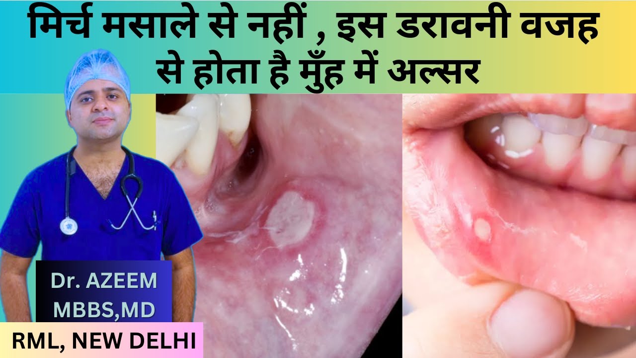 Mouth Ulcer causes in hindi | Apthous Ulcer |मुँह के छाले के कारण | Muh ...