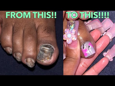 EXTREME ACRYLIC TOE TRANSFORMATION! | ACRYLIC TOE TUTORIAL!