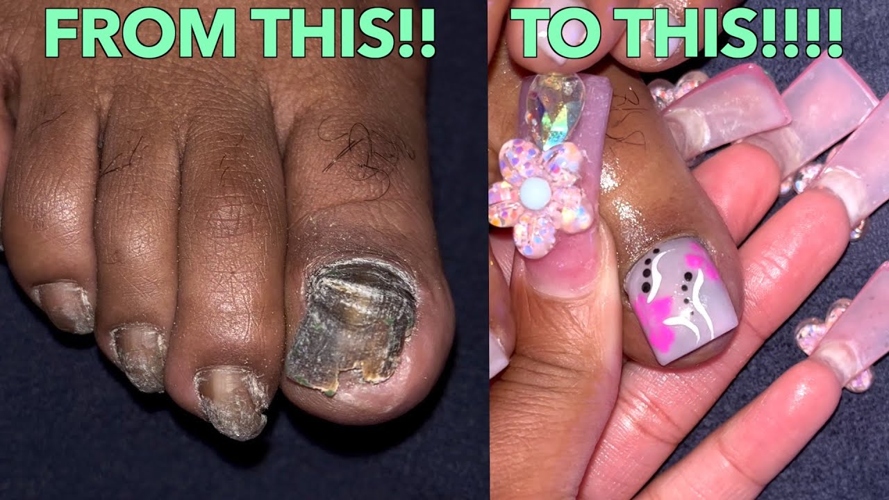 EXTREME ACRYLIC TOE TRANSFORMATION! | ACRYLIC TOE TUTORIAL! - YouTube