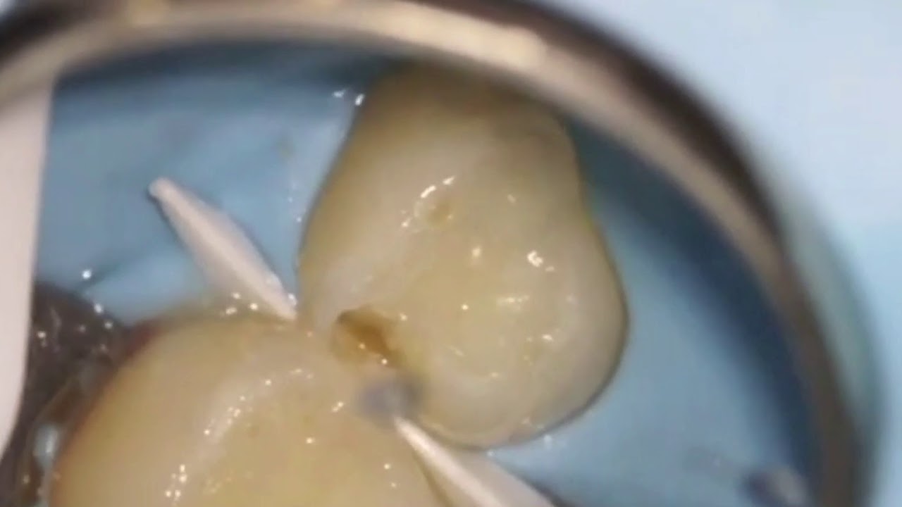 Restorasi GIC kls II - YouTube