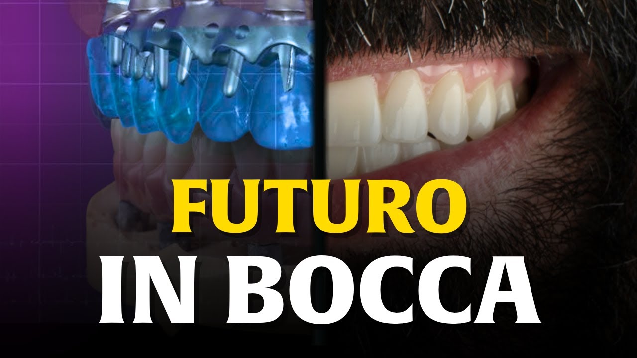 Sistema Bocca Bionica: implantologia dentale 4.0 - YouTube