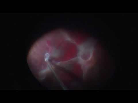 Lens sparing vitrectomy for tractional retinal detachment - YouTube