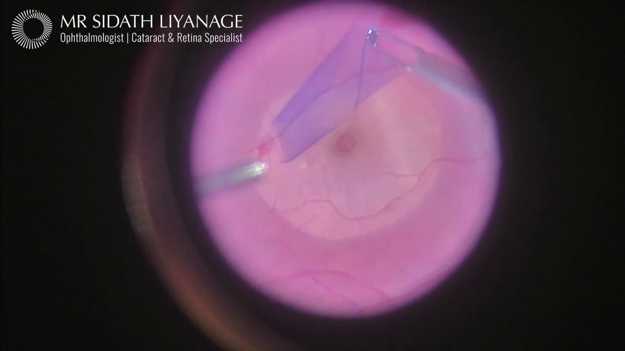 Macular hole surgery - YouTube