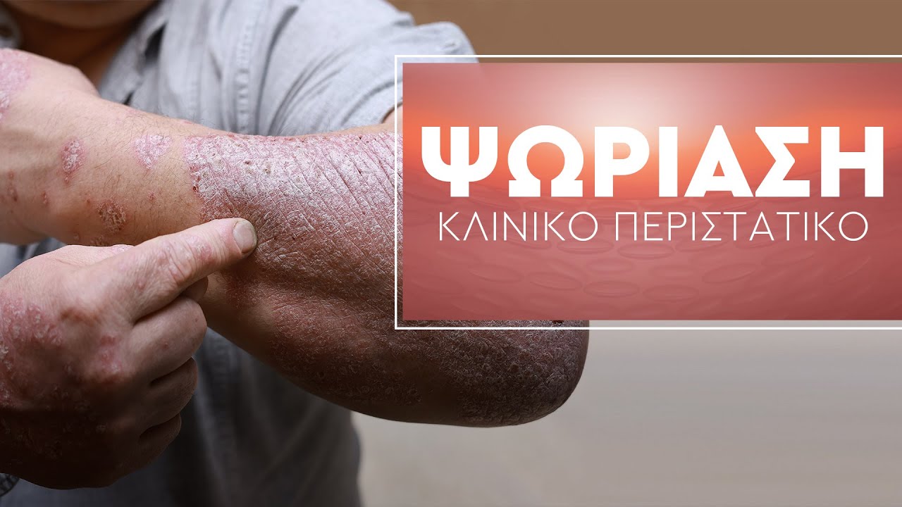 Ψωρίαση & Kλινικό Περιστατικό Ορθομοριακής Διατροφικής Ιατρικής - YouTube