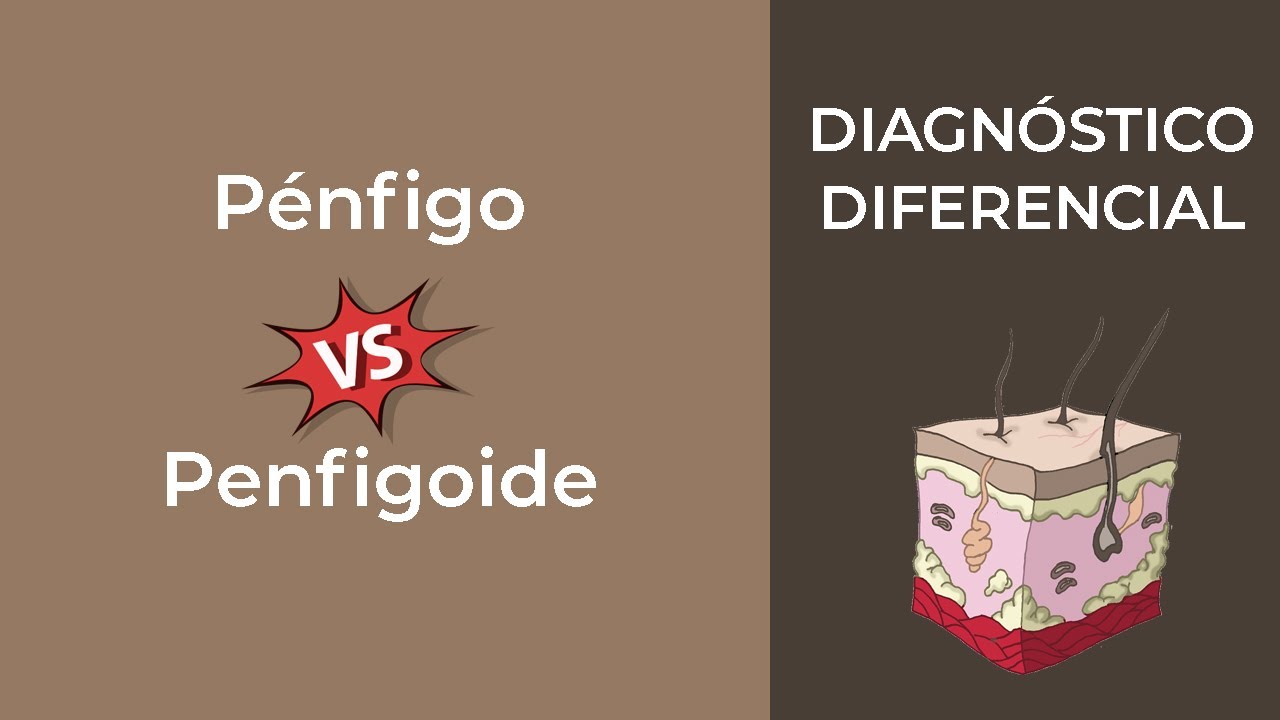 Penfigoide Vs Penfigo