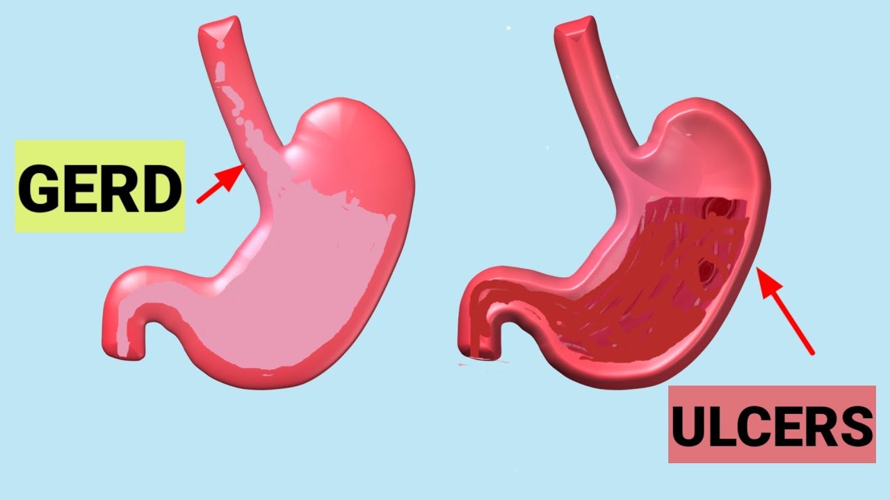 THE RIGHT TREATMENT FOR GERD AND GASTRITIS - YouTube