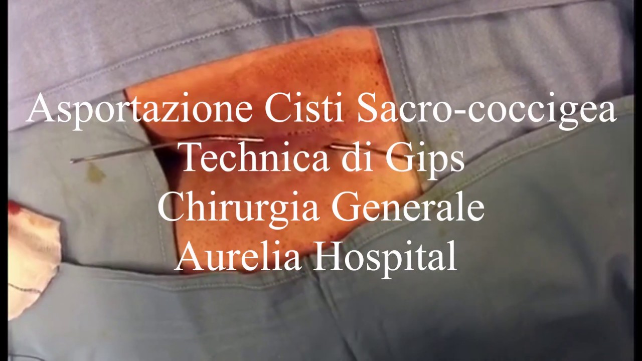 asportazione di cisti sacrococcigea secondo la tecnica di Gips. - YouTube