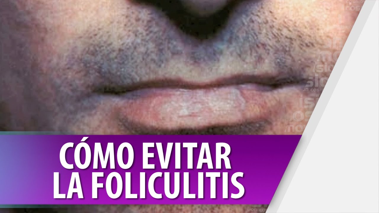 Cómo Evitar la Foliculitis - YouTube