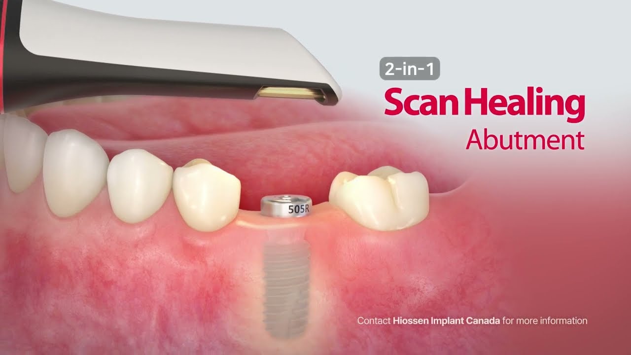 Scan Healing Abutment - Osstem Digital Workflow - YouTube