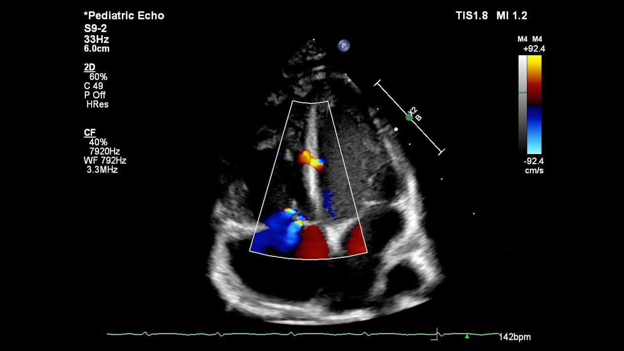 Basic echocardiography(심장 초음파 기본)- VSD(ventricular septal defect, 심실중격 ...