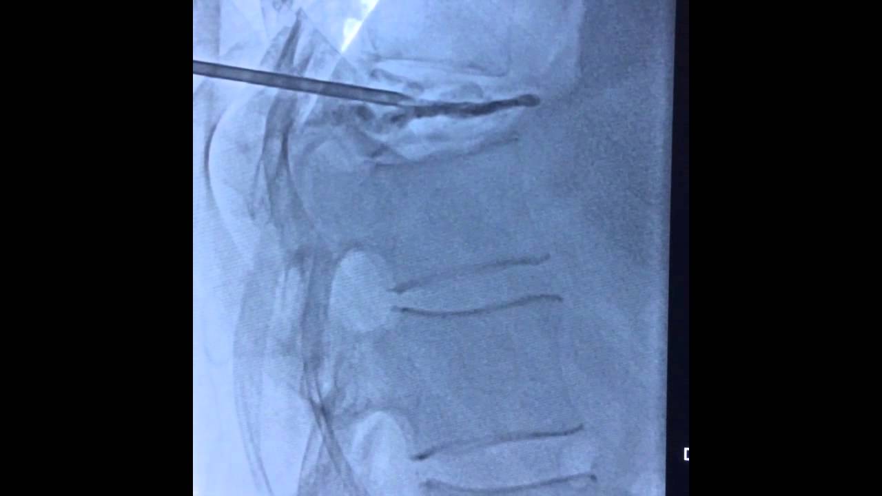 Percutaneous Vertebroplasty - YouTube